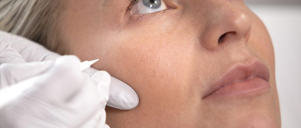 Profhilo Treatment London | WY Skin Clinic